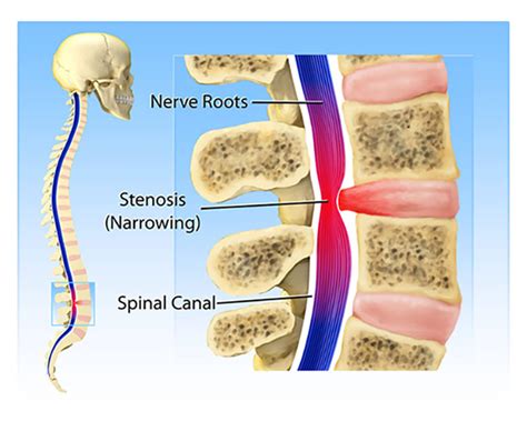 What Is Neural Foraminal Stenosis Of Lumbar Spine