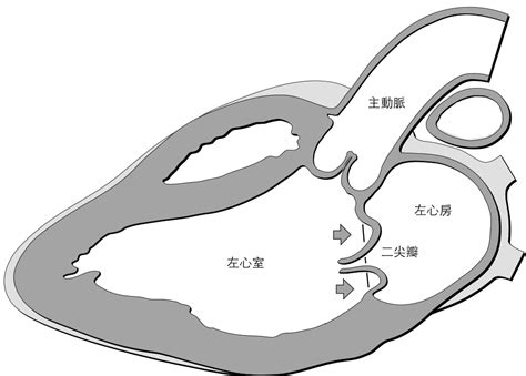 曝大s真正死因是心脏问题「先天性二尖瓣脱垂」，曾高烧时泡温泉，这种病有多严重？死亡与泡温泉关系大吗？ 知乎