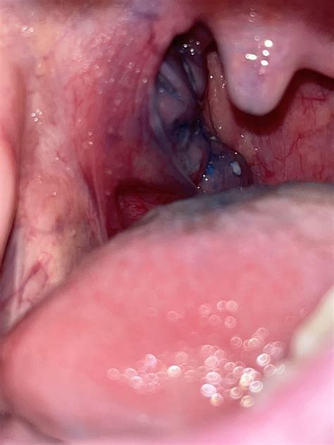 Tonsil Stones Please Help Rtonsilstones