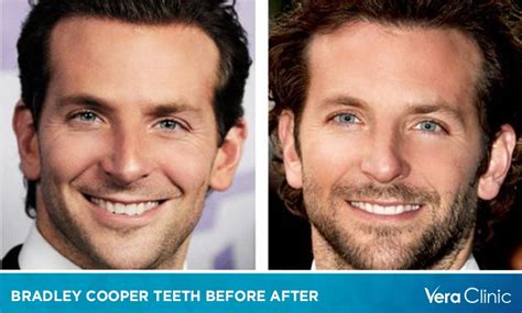 Bradley Cooper Facelift Before And After