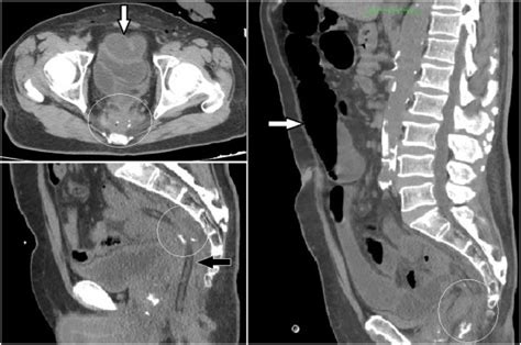 Rectal Stump Leakage A Neglected Complication After Hartmanns
