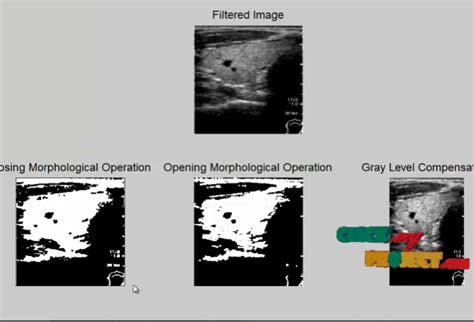 Thyroid Segmentation And Volume Estimation In Ultrasound Images