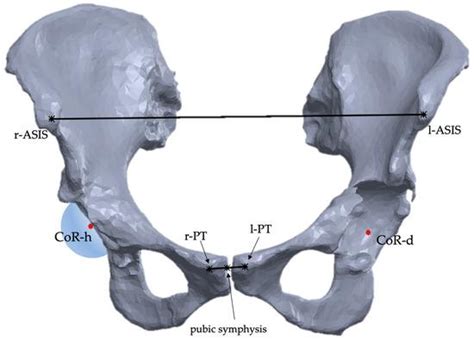 Medics On Linkedin Quantitative Assessment Of Acetabular Defects In Revision Hip Arthroplasty…