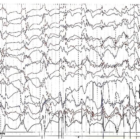 Three Month Prior Electroencephalogram Eeg Of A Patient With Epilepsy Download Scientific