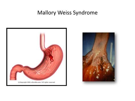 Mallory Weiss Causes At Deloris Smith Blog