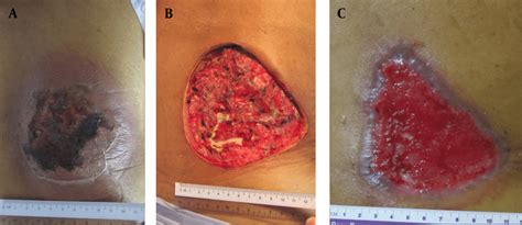 A A Carbuncle With A Necrotic Centre And Surrounding Cellulitis B