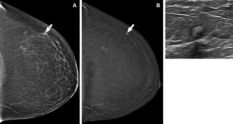 False Positive And False Negative Contrast Enhanced Mammograms