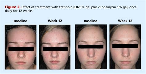 Tretinoin Cream Before And After Acne
