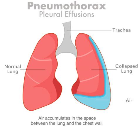 20 Pneumothorax Cartoon Stock Illustrations Royalty Free Vector