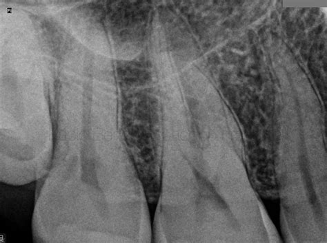 External Root Resorption Is Intentional Replantation A Real Option A