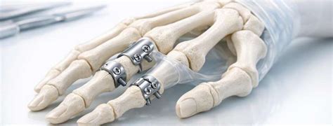 Hand Surgery For Arthritis Restoring Function And Reducing Pain