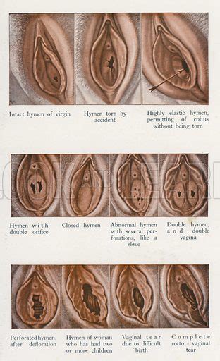States Of The Hymen Stock Image Look And Learn