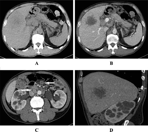 Nodular Subtype Non Enhanced Ct Scan Of The Abdomen Shows An