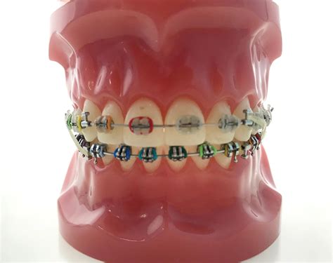 Class Ii Left Class Iii Right Elastics About Braces
