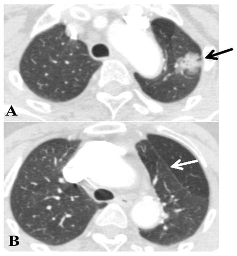 Long Term Follow Up In A Patient With Segmentectomy For Lung Cancer Developed In The Segment