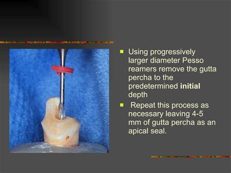 Post And Core Ppt Oral Care Personal Care