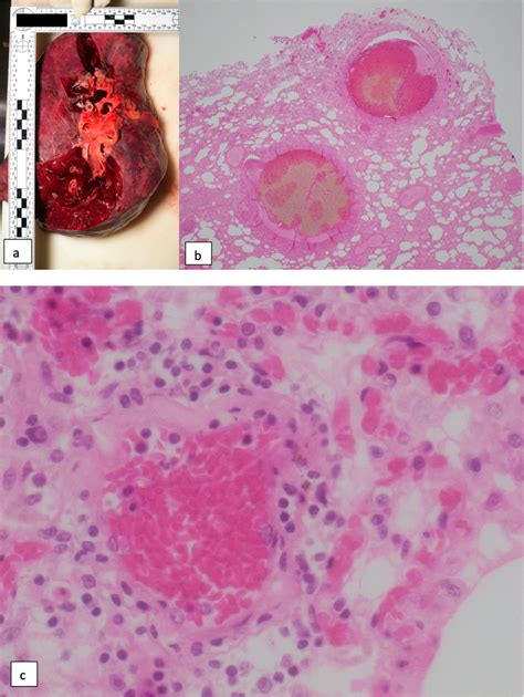 Pulmonary Autopsy Findings A The Lung With Multiple Emboli B