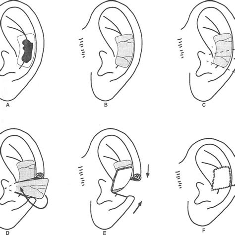 Pdf Reconstruction Of Non Marginal Ear Defect By A Postauricular Wedge Transposition Flap