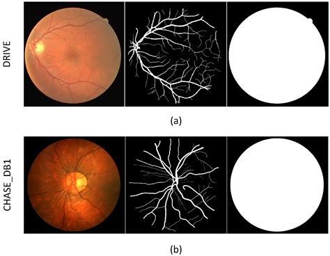 Improvement Of Retinal Vessel Segmentation Method Based On U Net