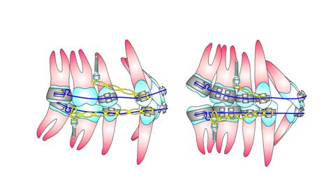 Мастърклас Огъване на ортодонтски дъги проф д р Джовани Бионди