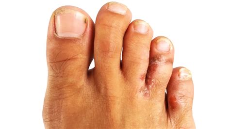 Natural Solutions For Fungal Skin Infections