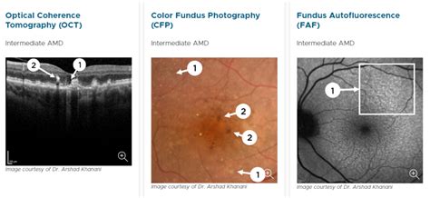 Youve Identified A Ga Patient Now What Women In Optometry