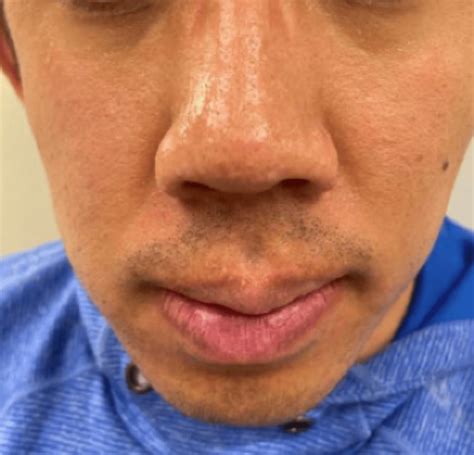Cowden Syndrome A Case Series Highlighting Cutaneous And Systemic