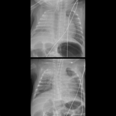Endotracheal Tube Placement In Neonates X Ray