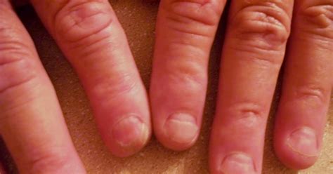 Happenings With Dom And Nan Fingernails After Chemo Total Body Radiation