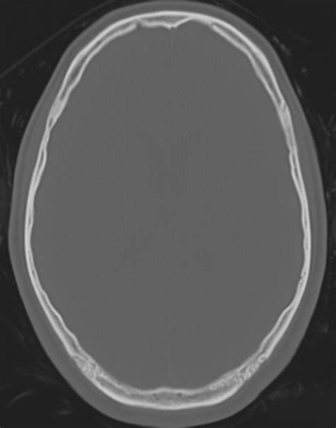 Ct Anatomy Of Brain Bone Window At Samuel Woolley Blog