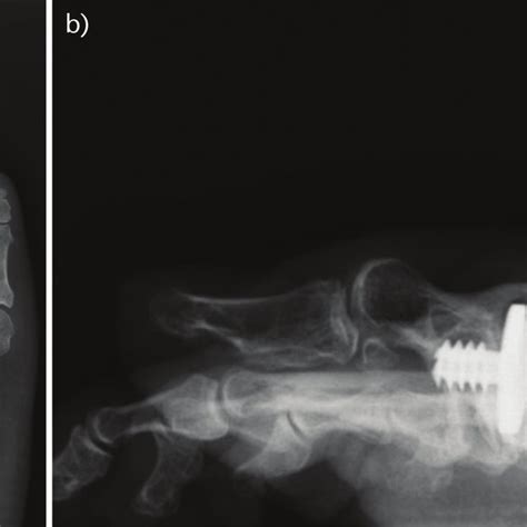 Hattrup And Johnson Radiographic Classification Of Hallux Rigidus Download Table