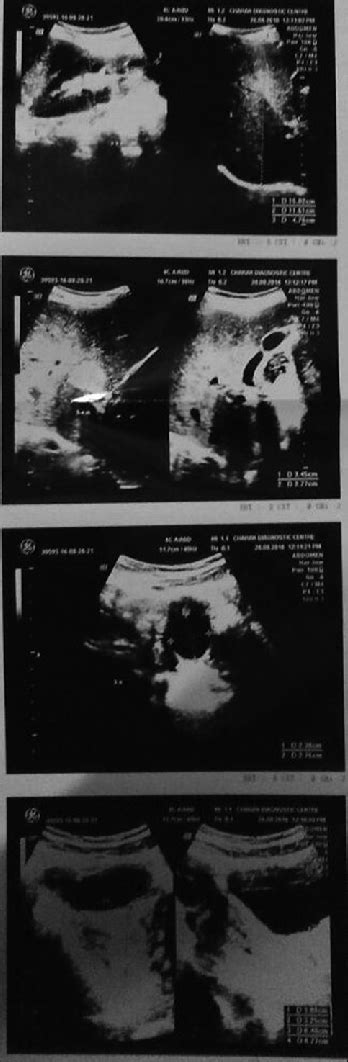 A Hypoechoic Space Occupying Lesion Is Seen In Segment V Of Liver Download Scientific Diagram