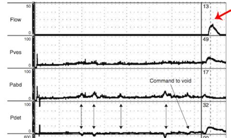 Neuropathy And Your Bladder Neuropathycommons