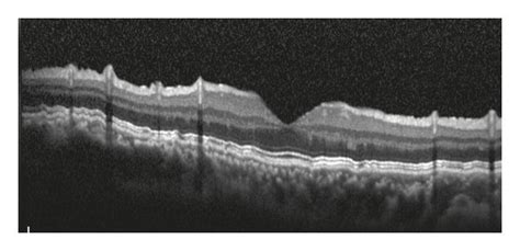 Fundus Photographs And Optical Coherence Tomographic Images In A