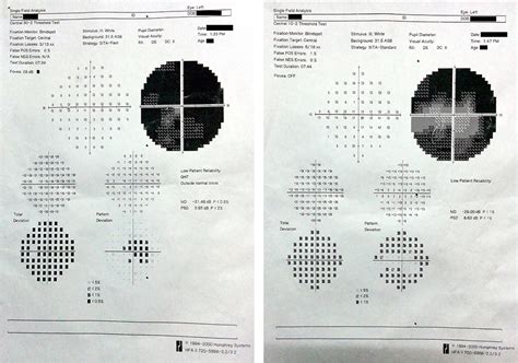 Ripasudil Endgame Role Of Rho Kinase Inhibitor As A Last Ditch Stand