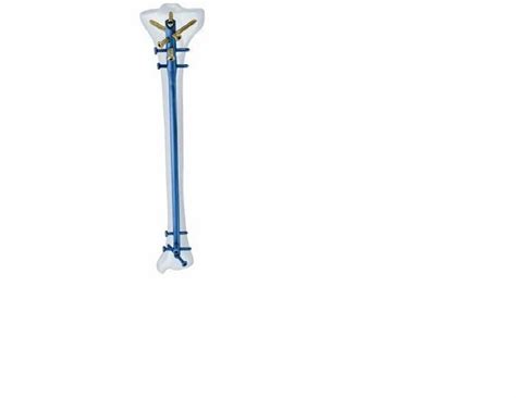 Titanium Interlocking Expert Tibial Nail At Rs 3000 In New Delhi Id 2854227348597