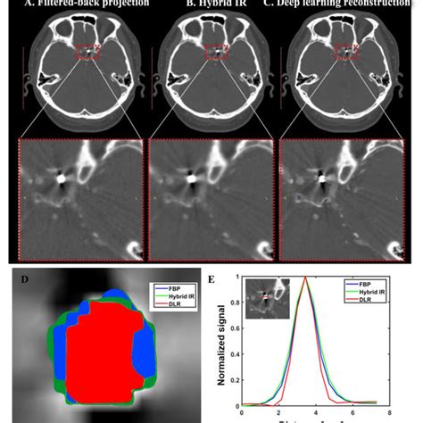 Examples Of Brain Cta Scan For A Coiled Aneurysm In The Left