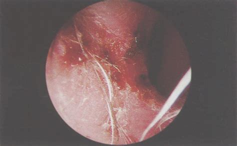 图29 鼻前庭炎 耳鼻咽喉科学彩色图谱