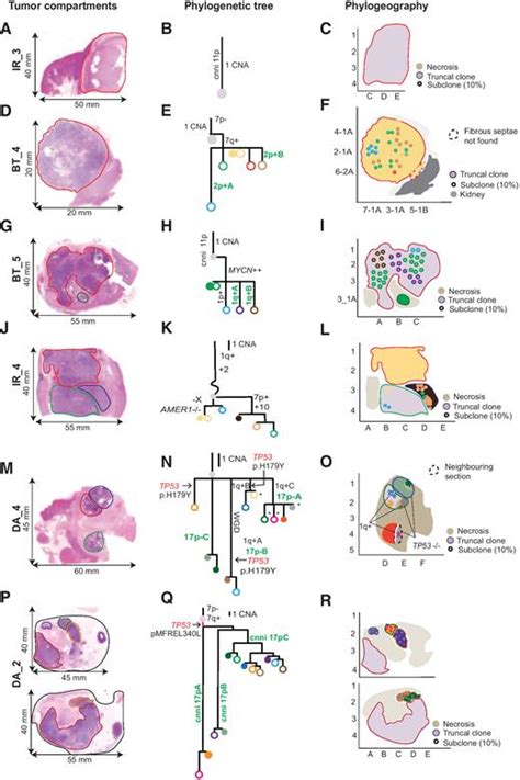 Resolving The Pathogenesis Of Anaplastic Wilms Tumors Through Spatial