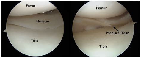 Our Experience In Meniscus Tears