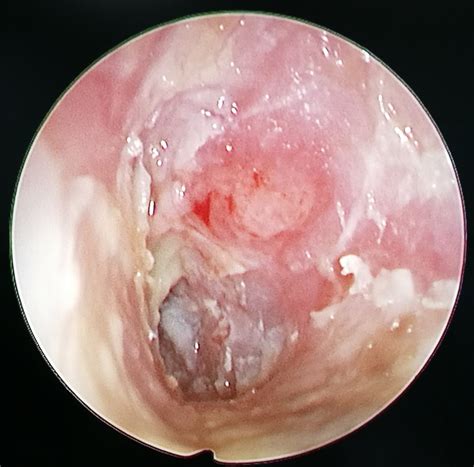 Otitis Externa Tympanic Membrane What Is Otitis Media