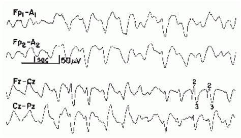 Metabolic Disorders And Eeg Neupsy Key