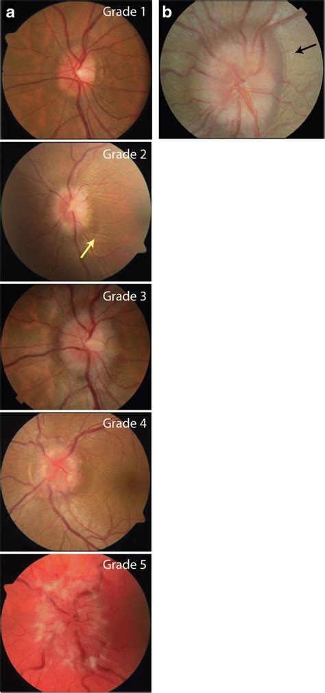 Fundoscopic Examples Of The Frisén Papilledema Grading Scale A Grade