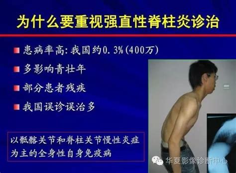 强制性脊柱炎的诊断要点与治疗原则 好医术文章 好医术 赋能医生守护生命