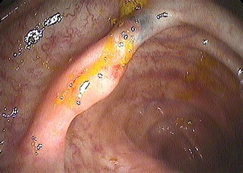 Flat Serrated Polyps At Ct Colonography Relevance Appearance And