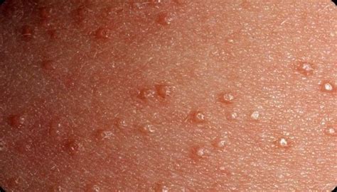 Lichen Nitidus Pictures Treatment Causes Diagnosis Symptoms
