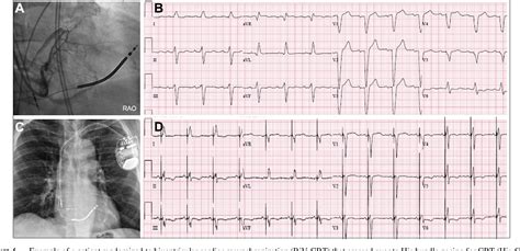 Figure 1 From On Treatment Comparison Between Corrective His Bundle Pacing And Biventricular