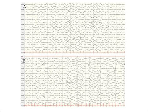 Eeg Findings In A Female Neonate With Stxbp1 Associated Ee At The Age
