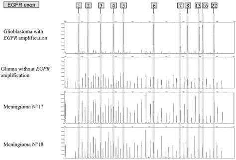 Egfr Gene Amplification Genomic Dnas From Glioma With And Without Egfr