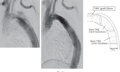Figure 2 From Thoracic Endovascular Aortic Repair For Descending Aortic